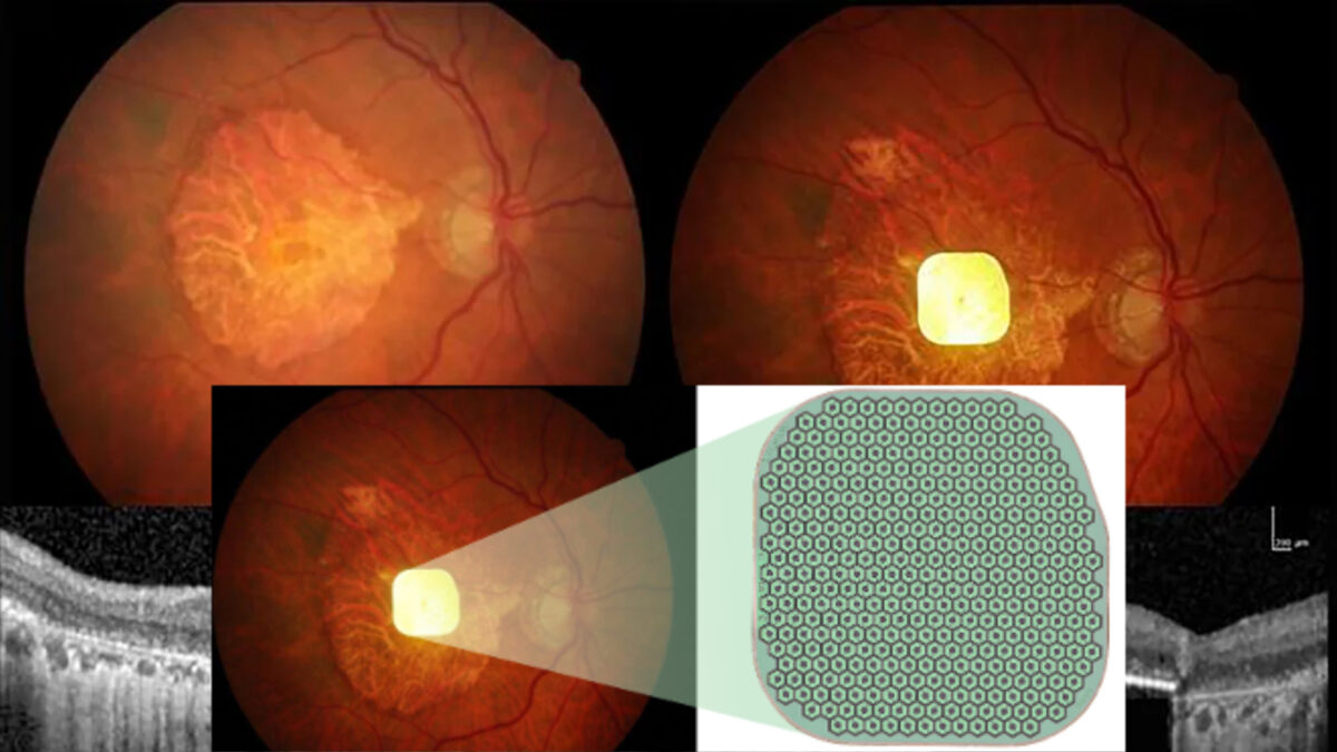 'New era in artificial vision...' — AI 'miracle' chip helps blind ...